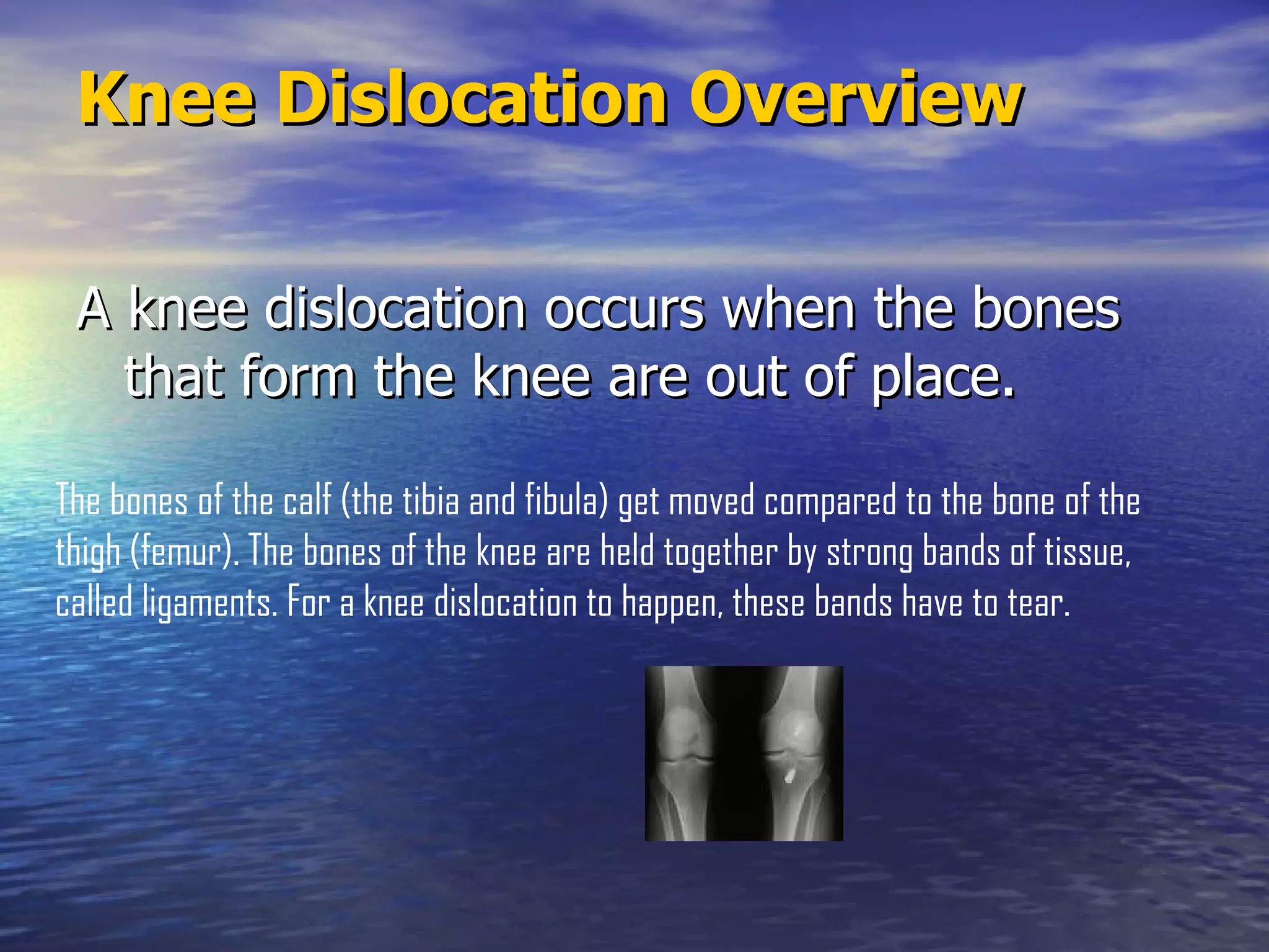 Knee Dislocation 2 | PPT
