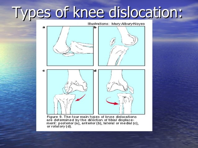 Knee Dislocation 2 | PPT