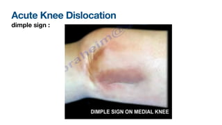 Knee Dislocation Orthopaedics MBBS Presentation | PPT