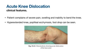 Knee Dislocation Orthopaedics MBBS Presentation | PPT