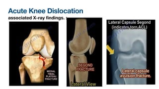 Knee Dislocation Orthopaedics MBBS Presentation | PPT