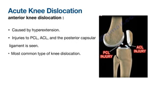 Knee Dislocation Orthopaedics MBBS Presentation | PPT