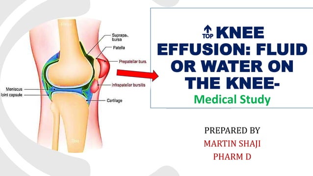 Knee effusion : Fluid Or Water On The Knee-Medical Study | PPTX