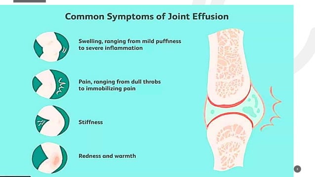 Knee effusion : Fluid Or Water On The Knee-Medical Study | PPT