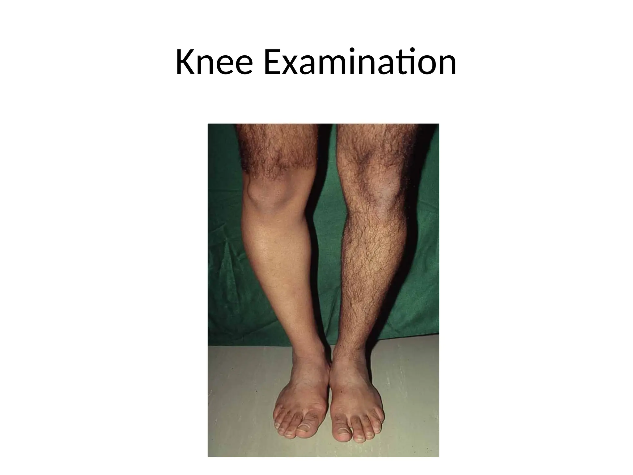 Msk Module Knee Examination In Orthopedics Ppt