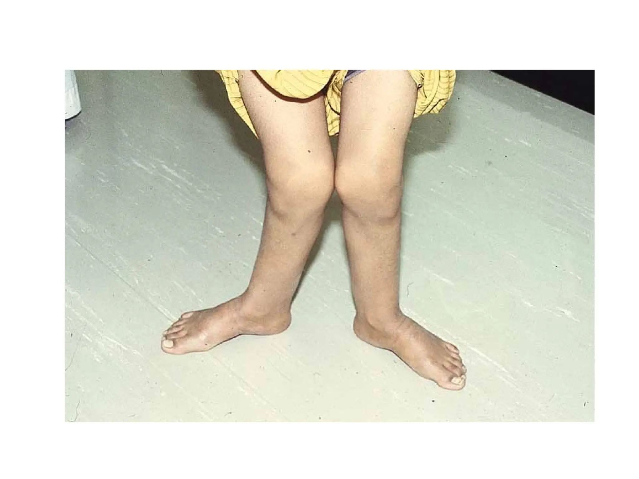 MSK Module Knee Examination in Orthopedics.ppt