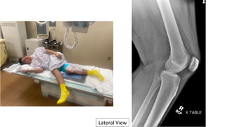Knee Extensor Mechanism Injuries - Orthopedic Radiologic Imaging | PDF