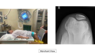 Knee Extensor Mechanism Injuries - Orthopedic Radiologic Imaging | PDF