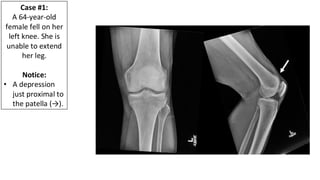 Knee Extensor Mechanism Injuries - Orthopedic Radiologic Imaging | PDF