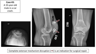 Knee Extensor Mechanism Injuries - Orthopedic Radiologic Imaging | PDF