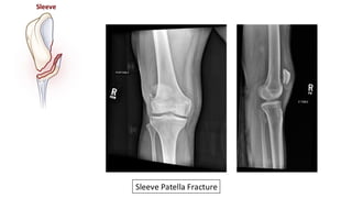Knee Extensor Mechanism Injuries - Orthopedic Radiologic Imaging | PDF
