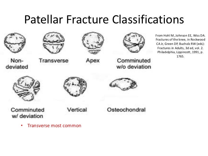 Knee fractures