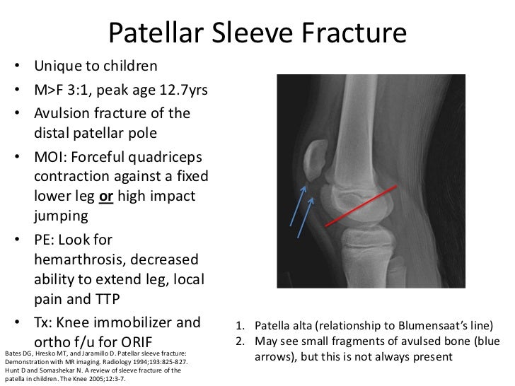 Knee fractures