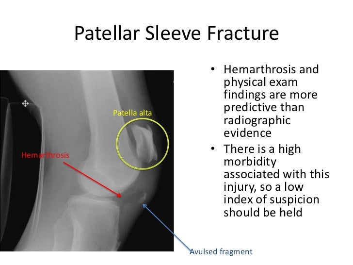 Knee fractures