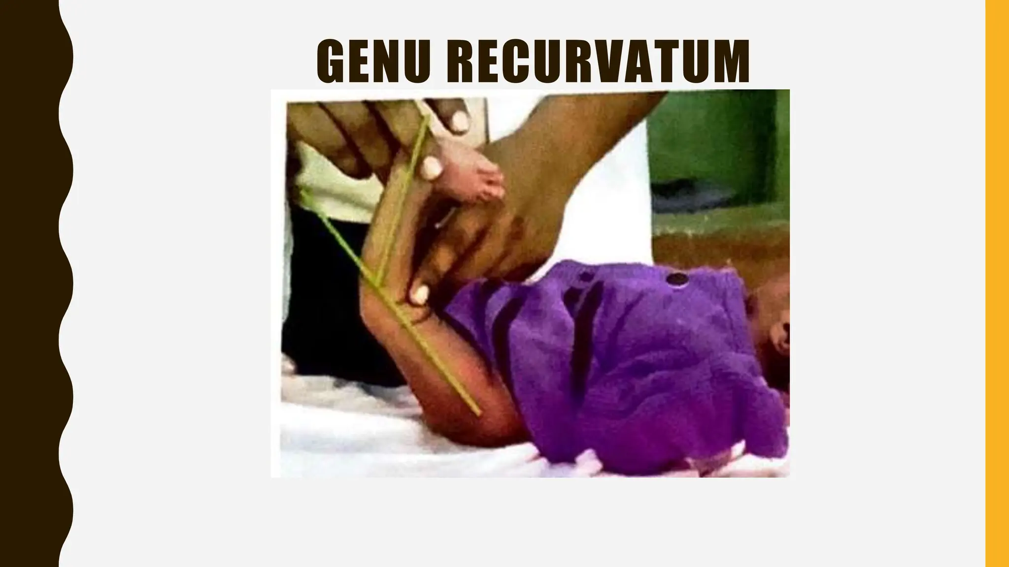 knee joint examination and common testss | PPT