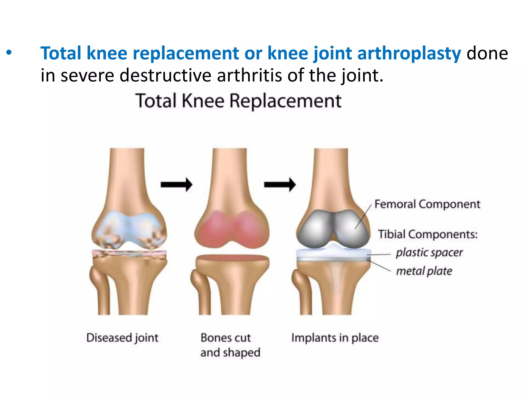 KNEE JOINT GK.pptx | Death, Injury, or Military Conflict | Sensitive Topics