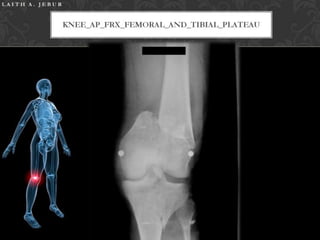 Knee joint x rays | PPSX