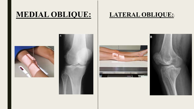 radiography positioning of knee and leg | PPTX