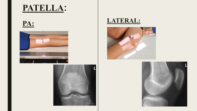 radiography positioning of knee and leg | PPTX
