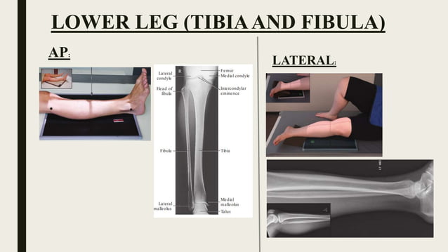 radiography positioning of knee and leg | PPTX