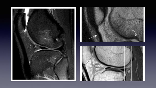 Knee ligament injury mri scan | PPT
