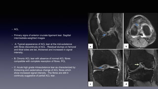 Knee ligament injury mri scan | PPT