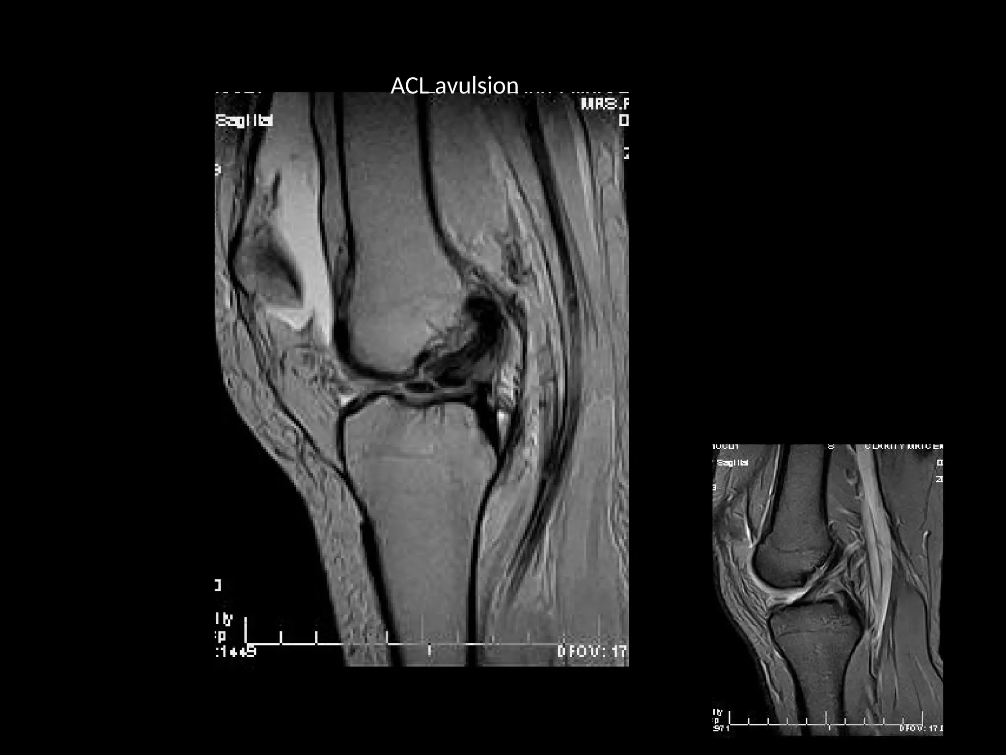 mri of the knee - acl pcl mensicus and collaterals | PPT