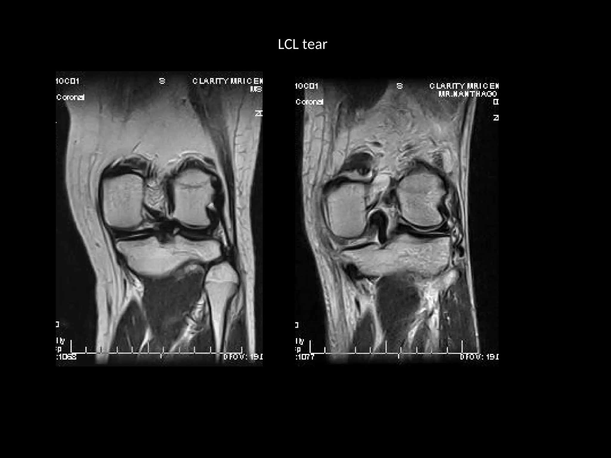 mri of the knee - acl pcl mensicus and collaterals | PPT