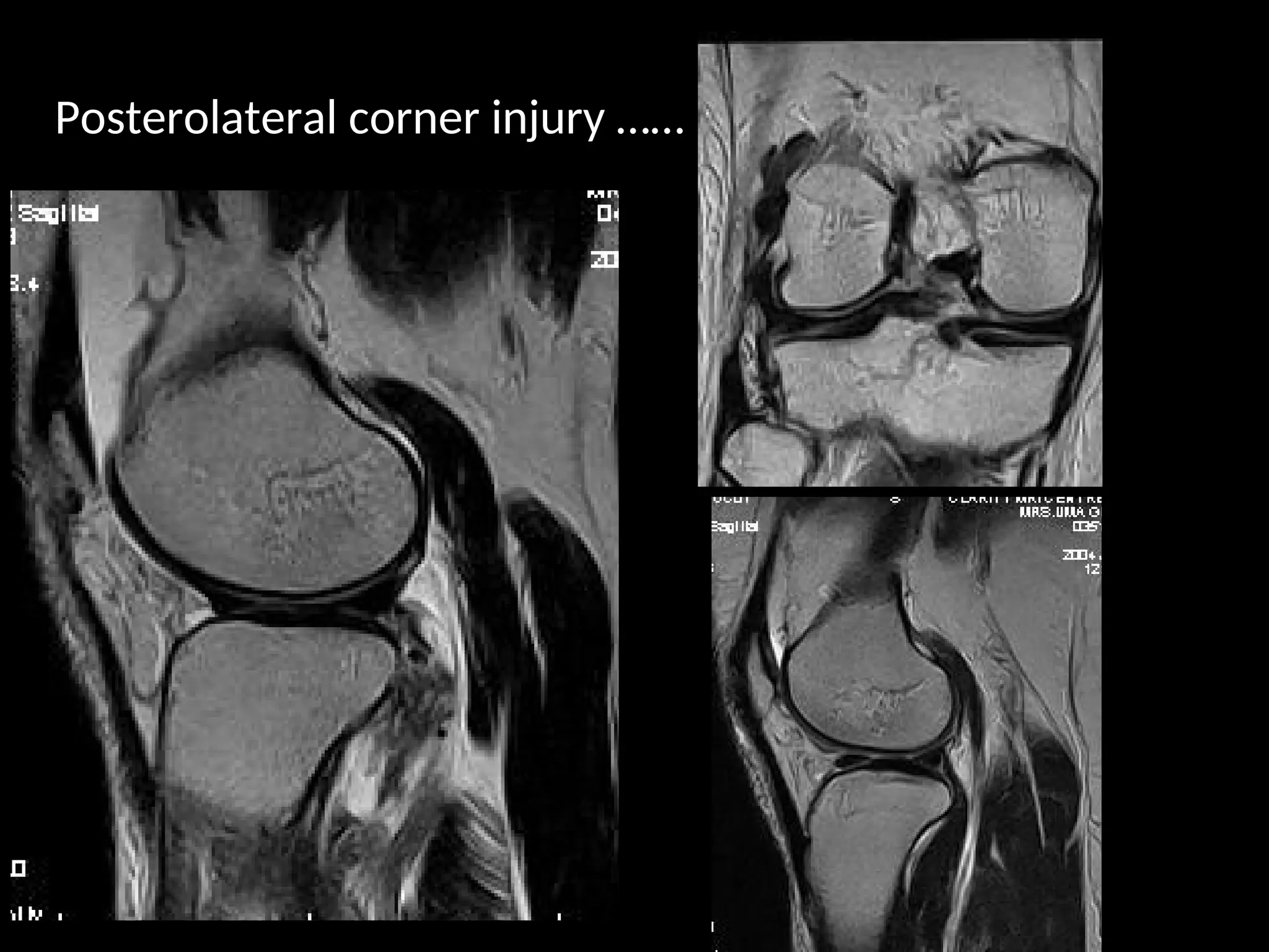 mri of the knee - acl pcl mensicus and collaterals | PPT