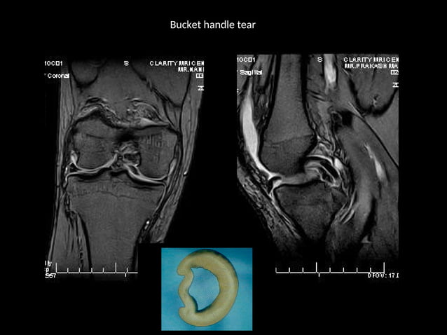 mri of the knee - acl pcl mensicus and collaterals | PPT