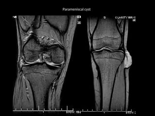mri of the knee - acl pcl mensicus and collaterals | PPT
