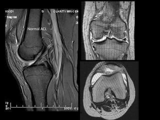 mri of the knee - acl pcl mensicus and collaterals | PPT