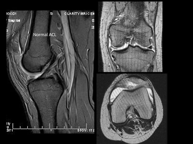mri of the knee - acl pcl mensicus and collaterals | PPT