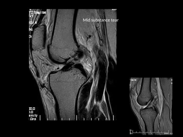 mri of the knee - acl pcl mensicus and collaterals | PPT