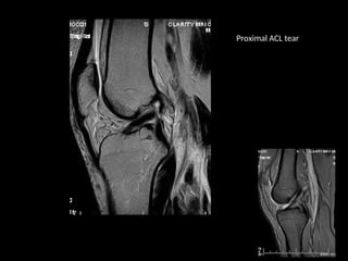 mri of the knee - acl pcl mensicus and collaterals | PPT