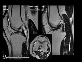mri of the knee - acl pcl mensicus and collaterals | PPT