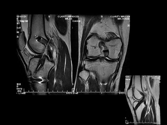 mri of the knee - acl pcl mensicus and collaterals | PPT