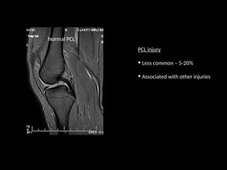 mri of the knee - acl pcl mensicus and collaterals | PPT