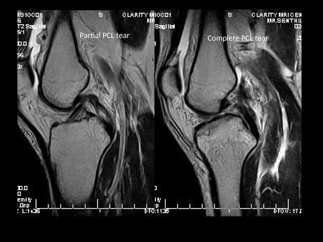 mri of the knee - acl pcl mensicus and collaterals | PPT