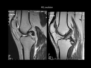 mri of the knee - acl pcl mensicus and collaterals | PPT
