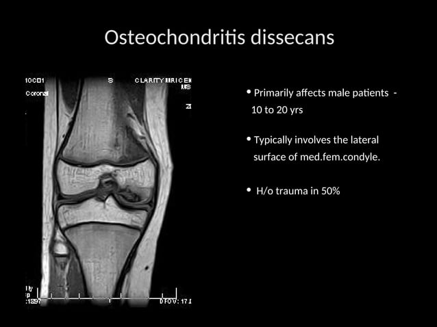mri of the knee - acl pcl mensicus and collaterals | PPT