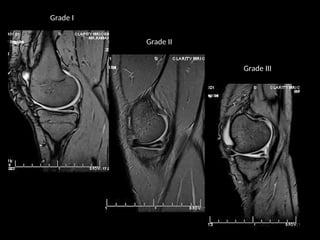 mri of the knee - acl pcl mensicus and collaterals | PPT