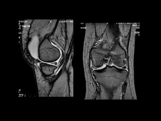 mri of the knee - acl pcl mensicus and collaterals | PPT