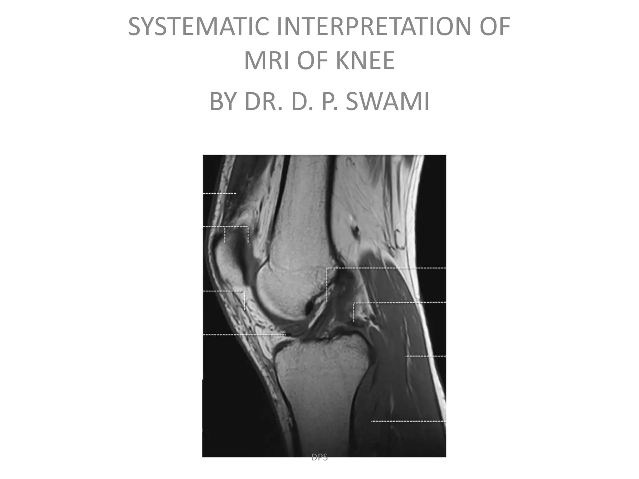 Knee mri: systematic interpretation by dr. d. p. swami | PPTX | Death, Injury, or Military ...