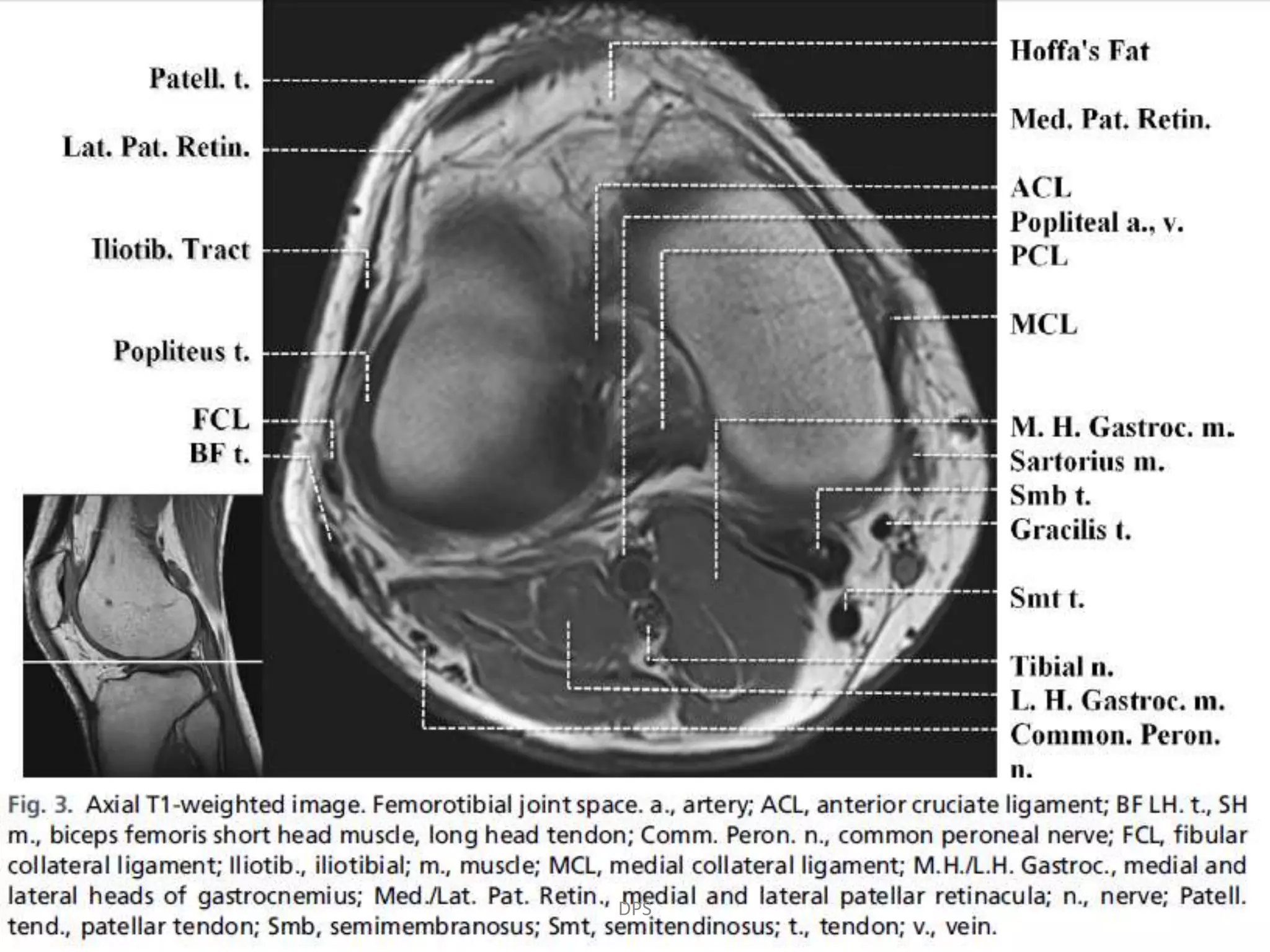 Knee mri: systematic interpretation by dr. d. p. swami | PPTX | Death, Injury, or Military ...