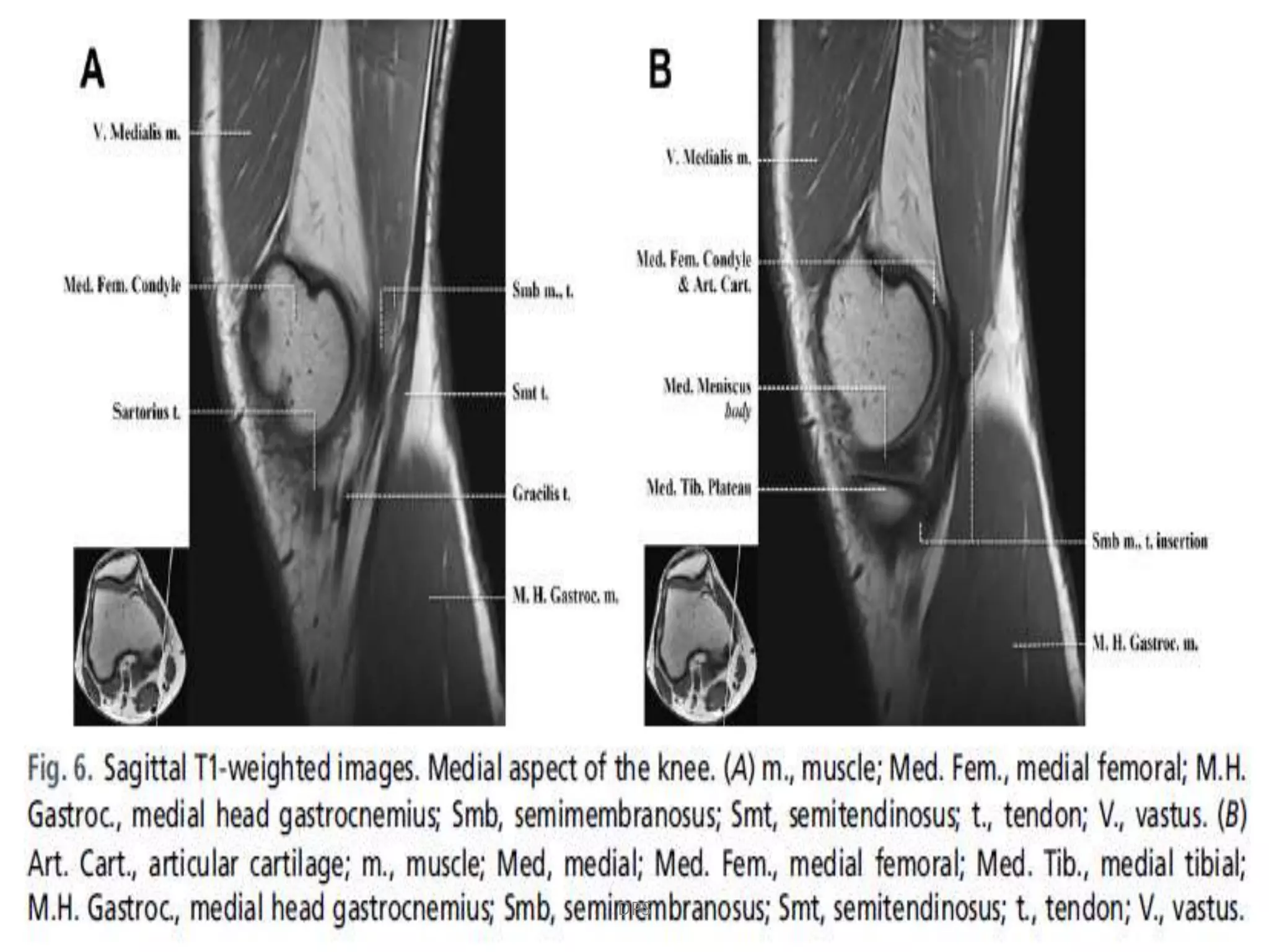 Knee mri: systematic interpretation by dr. d. p. swami | PPTX | Death, Injury, or Military ...
