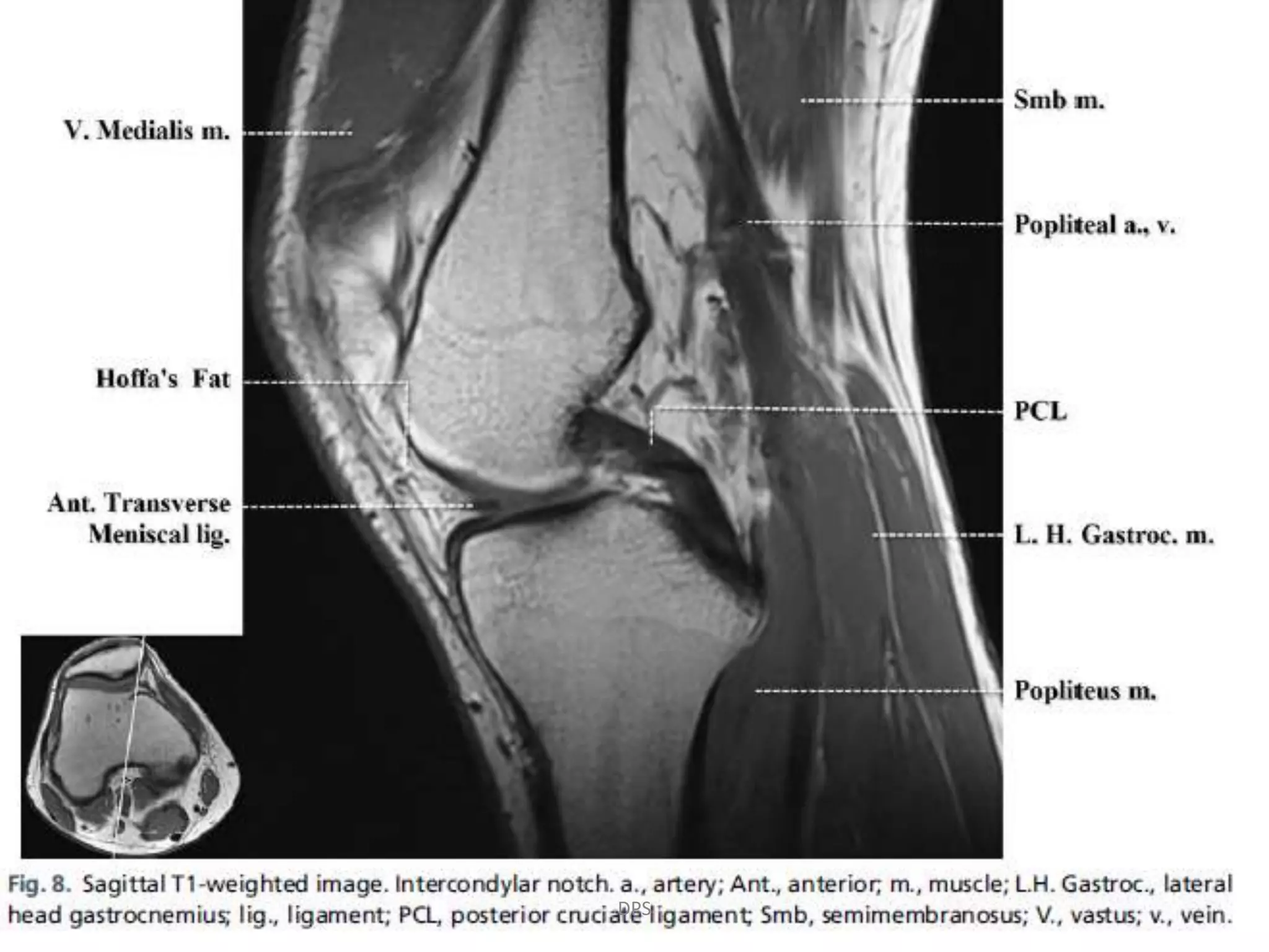 Knee mri: systematic interpretation by dr. d. p. swami | PPTX | Death, Injury, or Military ...