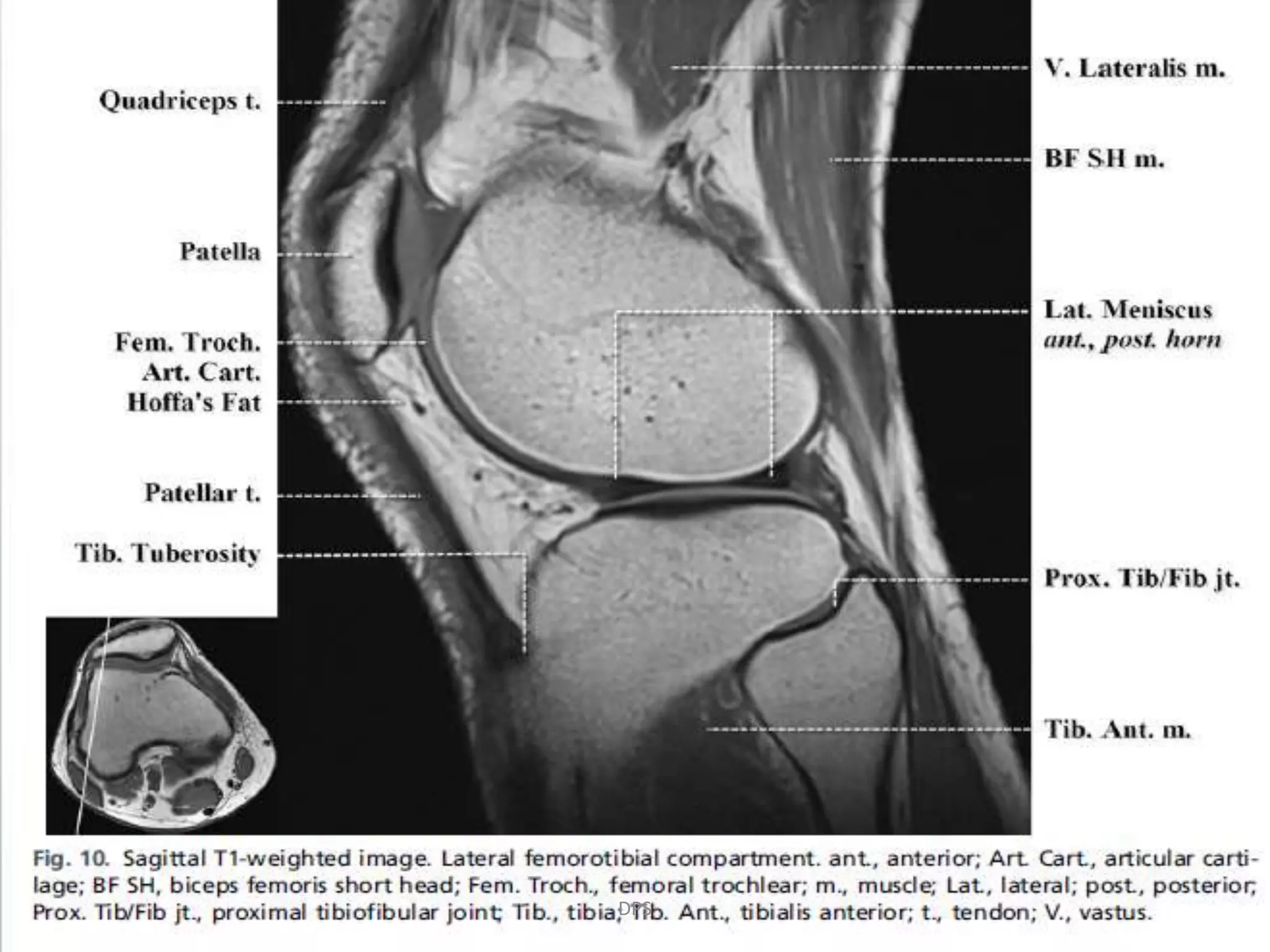 Knee mri: systematic interpretation by dr. d. p. swami | PPTX | Death, Injury, or Military ...