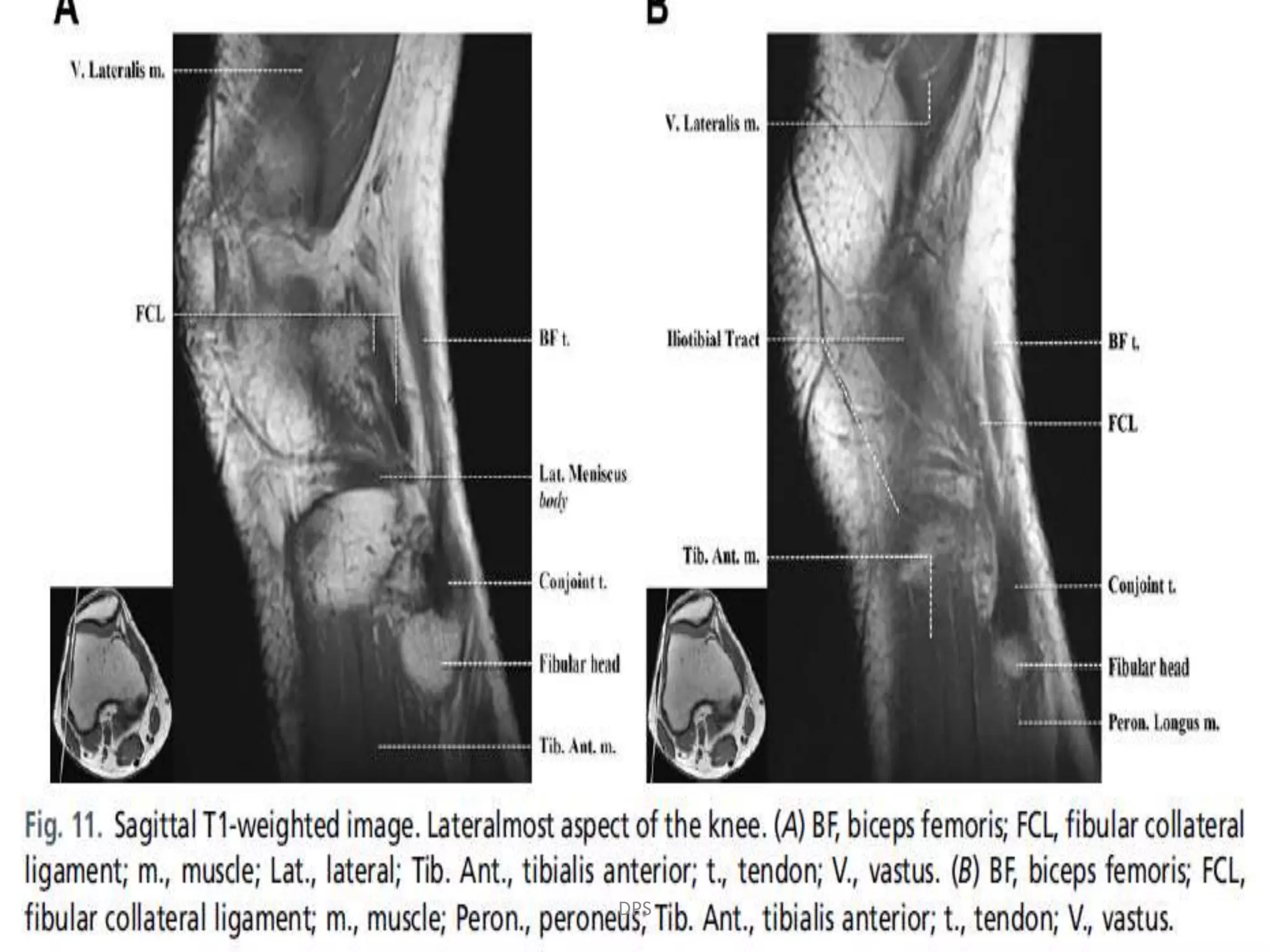Knee mri: systematic interpretation by dr. d. p. swami | PPTX | Death, Injury, or Military ...
