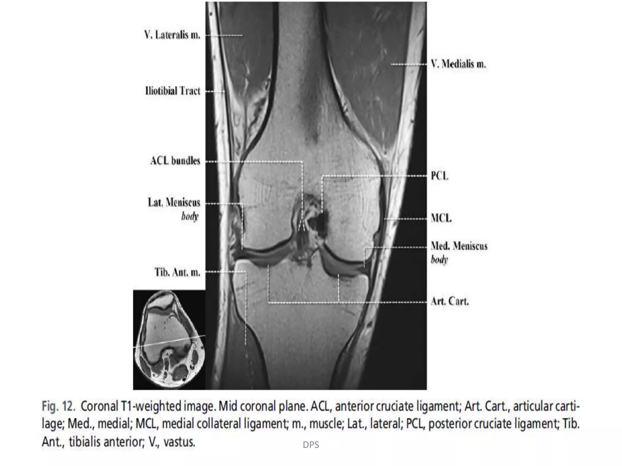 Knee mri: systematic interpretation by dr. d. p. swami | PPTX | Death, Injury, or Military ...